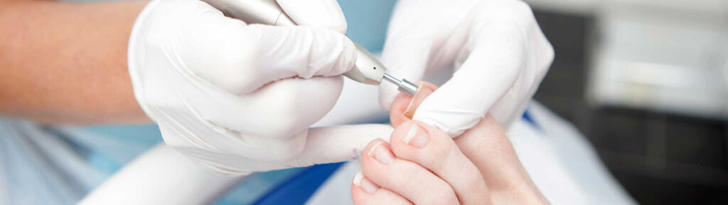 Ingrown Nail Surgery - Crows Nest Podiatry